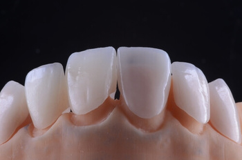 Can Veneers Fall Off? | Beyond 32 Dental