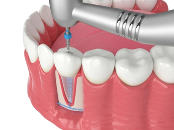 How Long Does a Root Canal Take? Essential Insights