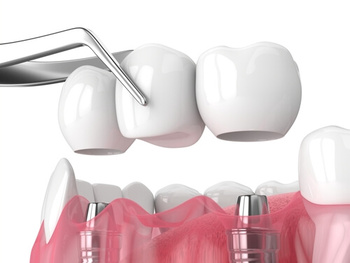 Dental Bridge Cost: What Impacts the Total Price?