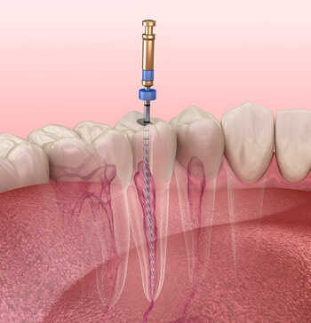 Root Canal Before and After: How Treatment Restores Teeth